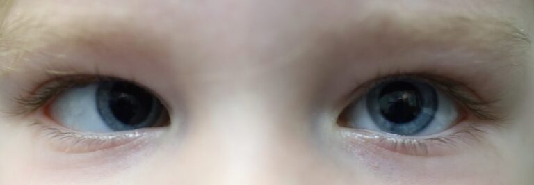Understanding Strabismus in Adults: Causes, Diagnosis & Treatment
