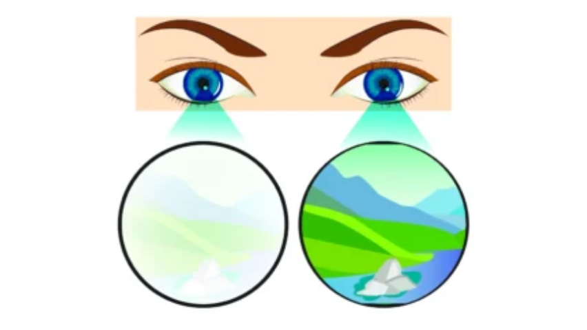 Amblyopia Lazy Eye Causes Symptoms And Treatment