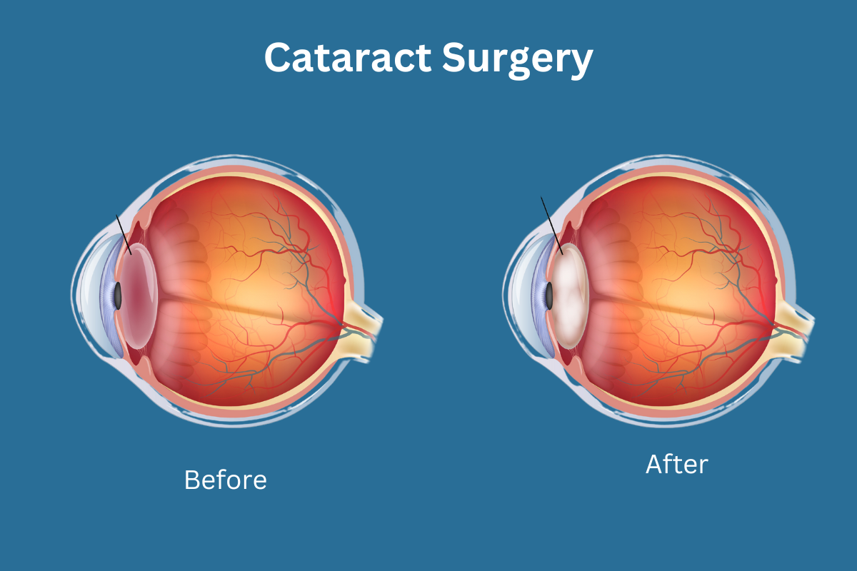 Cataract Surgery in Children: Everything You Need to Know About