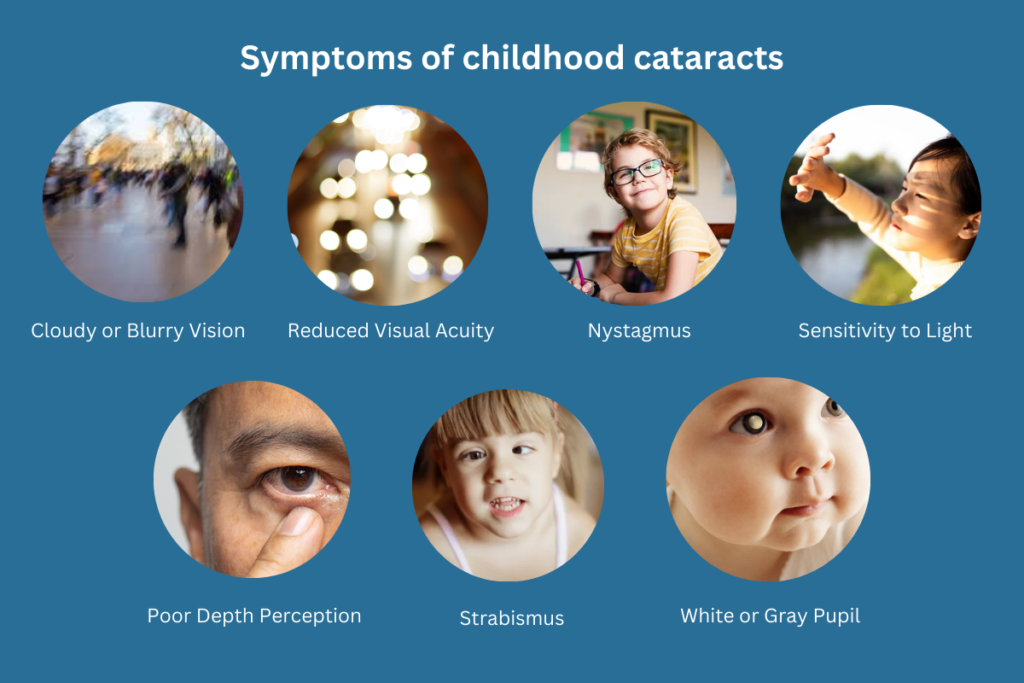 Cataract Surgery in Children: Everything You Need to Know About