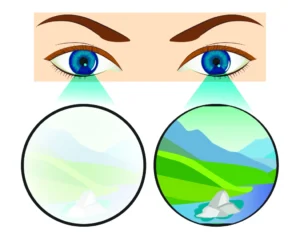 Amblyopia (Lazy Eye) - Causes, Symptoms and Treatment