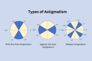Astigmatism: Symptoms, Causes, Diagnosis and Treatment Guide