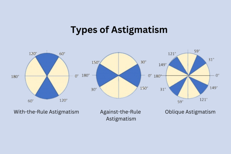 Astigmatism: Symptoms, Causes, Diagnosis and Treatment Guide
