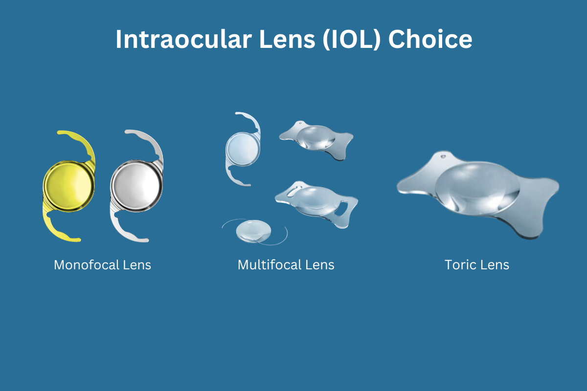 Cataract Surgery in Patients with Diabetes: Key Considerations