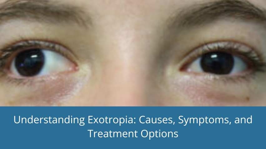Exotropia: Causes, Symptoms and Treatment Guide