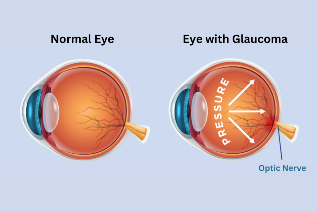 Understanding Paediatric Glaucoma & its impact on children